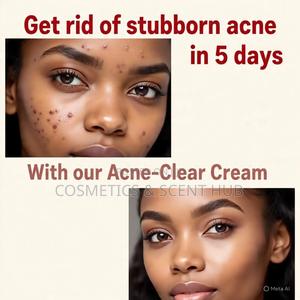 Get Rid of Stubborn Acne in 5 Days in Port-Harcourt - Face Care ...
