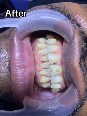 Scaling and Polishing With Stain Removal in Shomolu - Health & Beauty ...